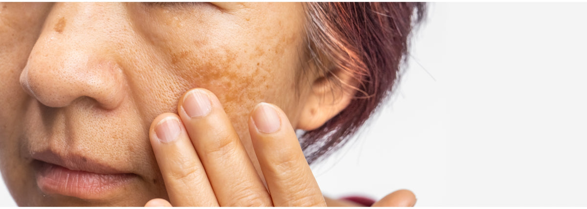How to Rebalance Pigmentation Naturally – Eco Diva Natural