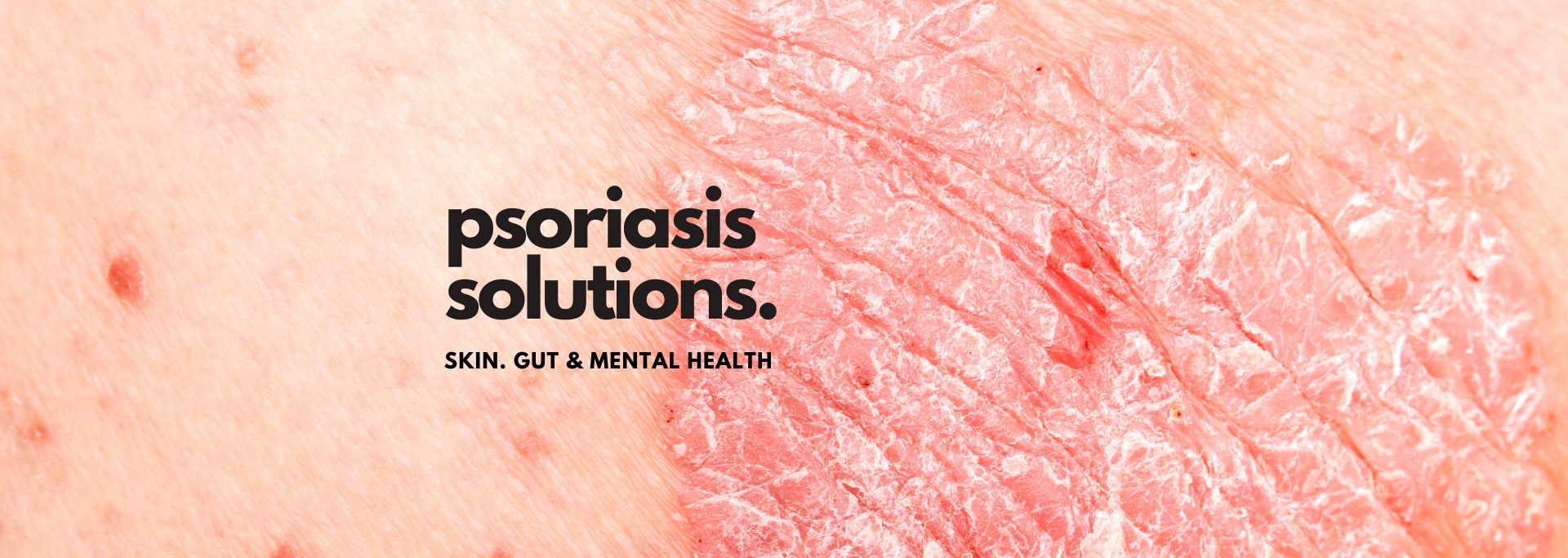 Managing Psoriasis Naturally: The Power of Skin, Gut, and Mental Healt ...